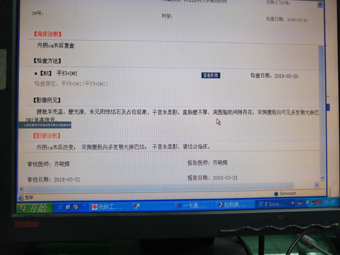 外阴鳞状细胞癌～～外阴鳞状细胞癌IB1期