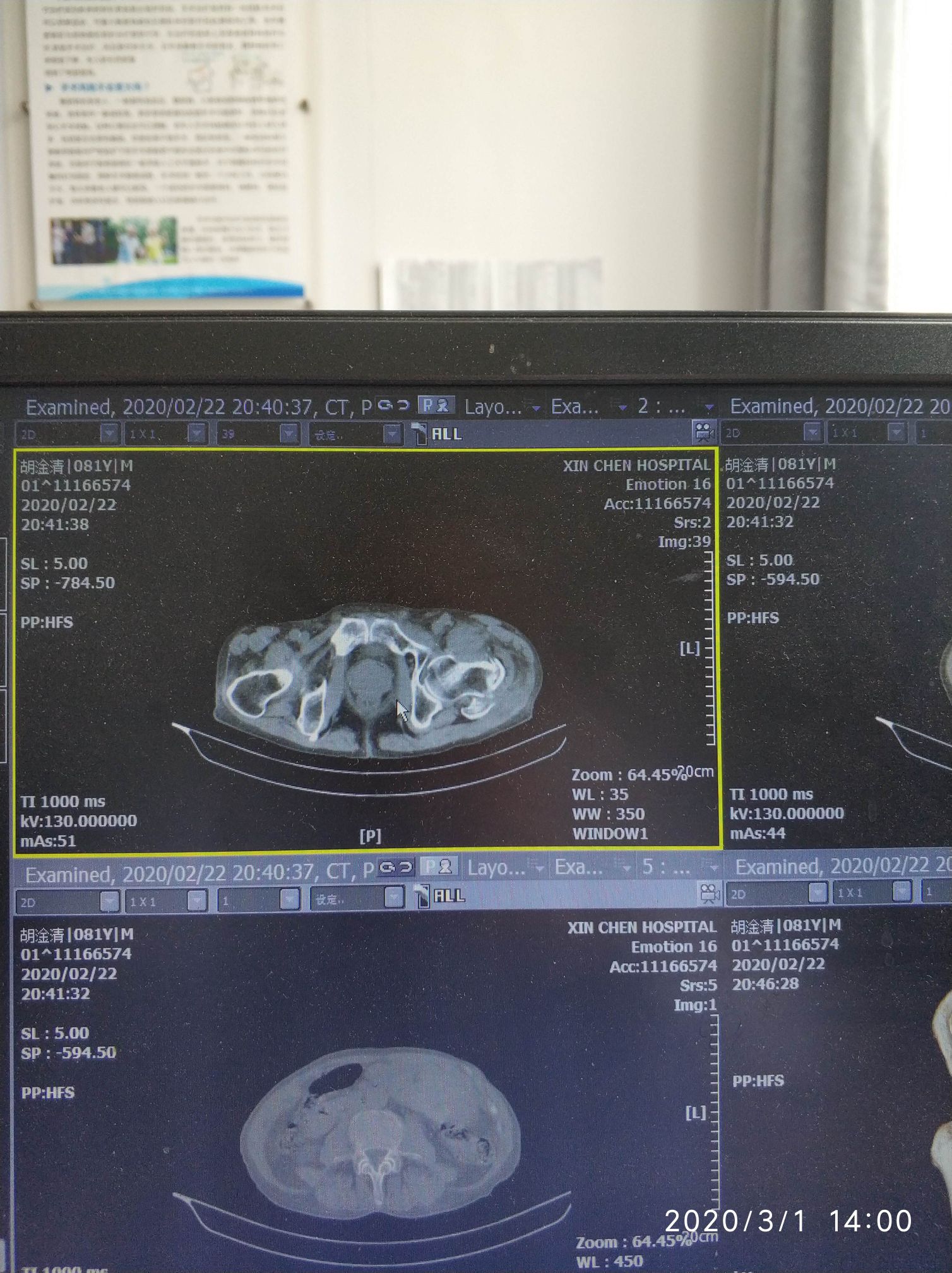 左股骨粗隆间骨折Intertan内固定