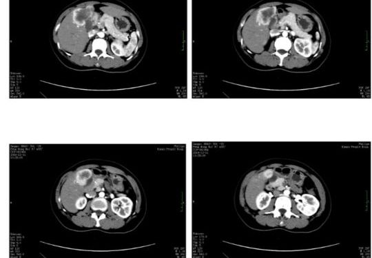 主诉：体检发现左肝占位6天。
