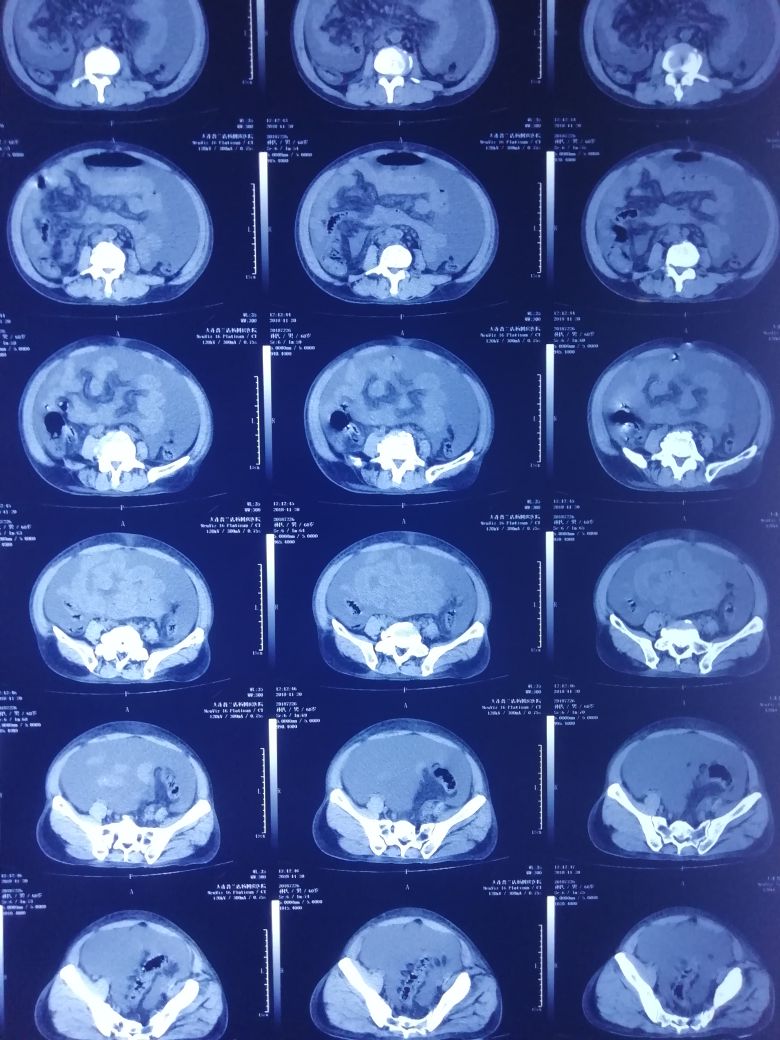 肝硬化失代偿期伴大量腹腔积液一例