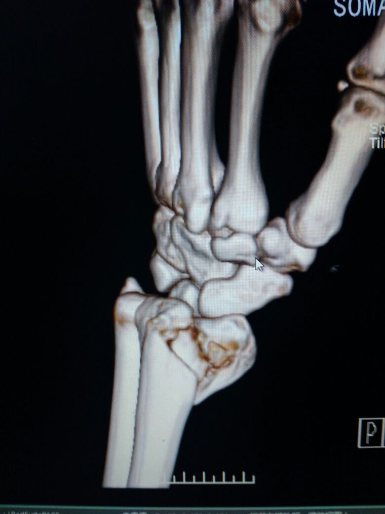 barton骨折手术治疗