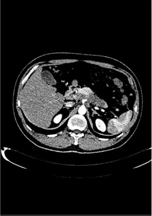 改良式Appleby手术