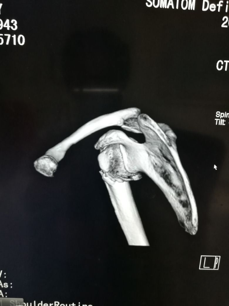 肱骨近端骨折Neer III型