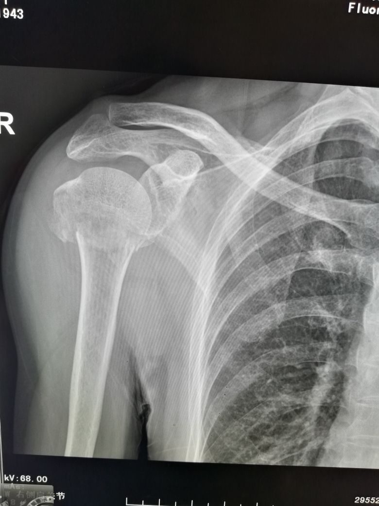 肱骨近端骨折Neer III型