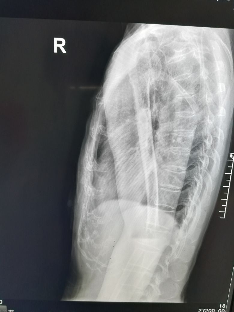 肱骨近端骨折Neer III型