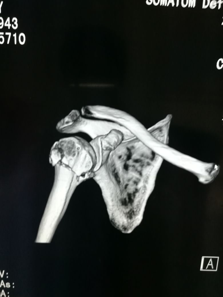 肱骨近端骨折Neer III型